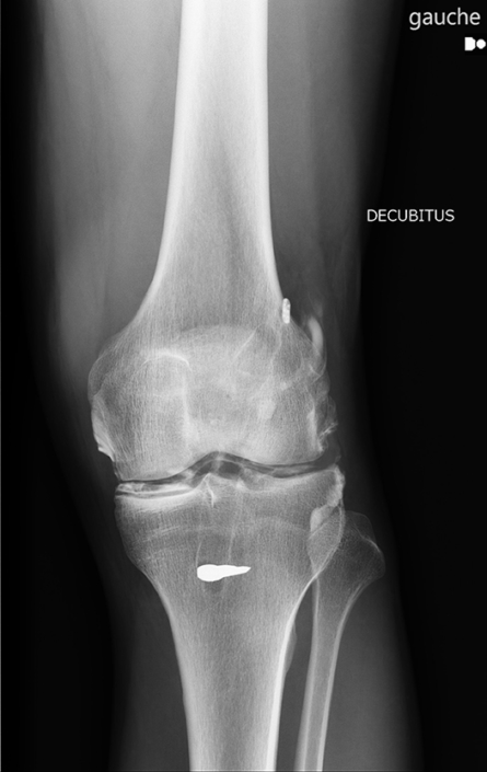 Infiltration articulaire sous radiographie - RDV en ligne