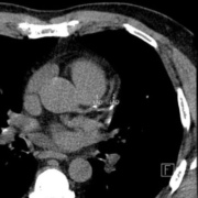 Score calcique coronaire - RDV en ligne